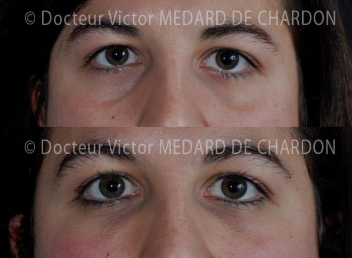 Photos avant après d'injections d'acide hyaluronique