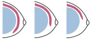 Augmentation mammaire par prothèses | Dr Médard de Chardon